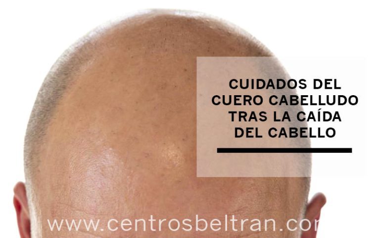 Cuidados del cuero cabelludo tras la caída del cabello - Centros Beltran