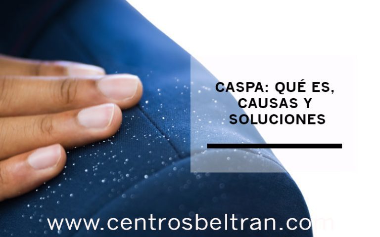 Caspa: qué es, tipos, causas y cómo eliminarla - Centros Beltran